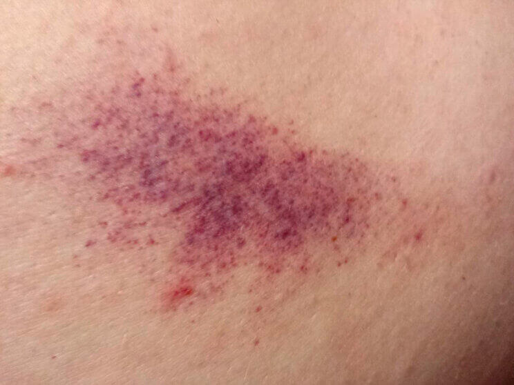 Blaue Flecken können viele Ursachen haben - ParaMediForm